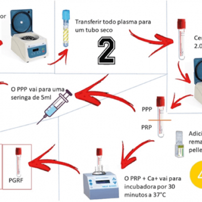 Plasma gel for dentistry: beauty is in the blood - Dentflex